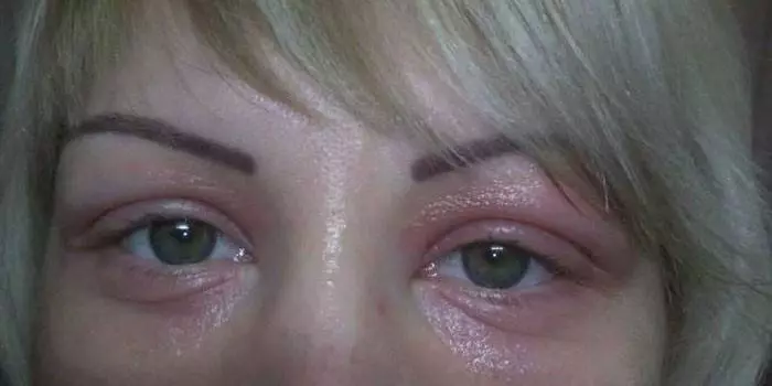 O femeie are umflături alergice ale pleoapelor