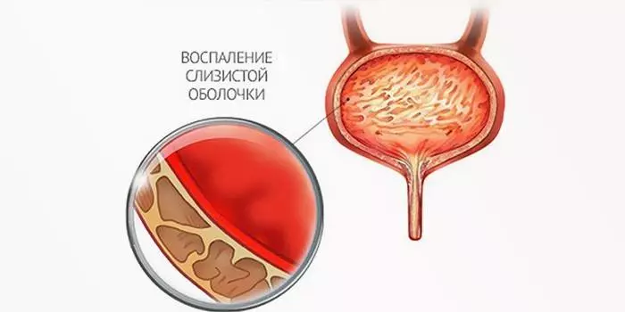 Kuzvimba kwedundira mucosa