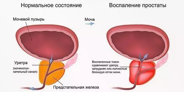 Kumburin prostate