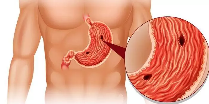 Stomach ulcer