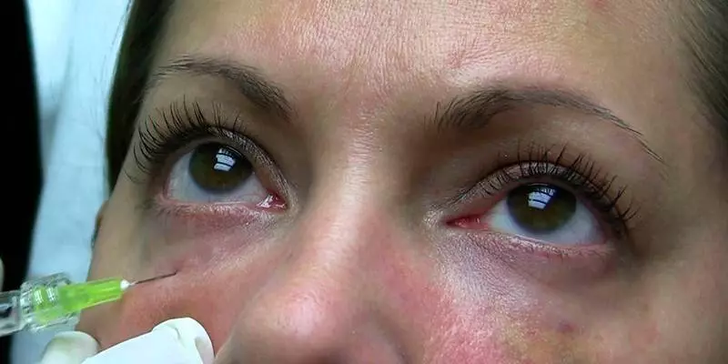 એક મહિલાને આંખો હેઠળ ઇન્જેક્ટ કરવામાં આવે છે