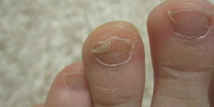 Fungus-affected toenails in a child