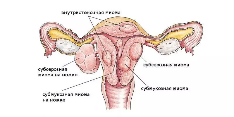 Klasifikimi i fibroideve sipas vendndodhjes së tyre në lidhje me mitrën