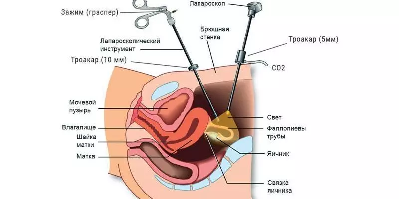 Laparoskopia e fibroideve të mitrës