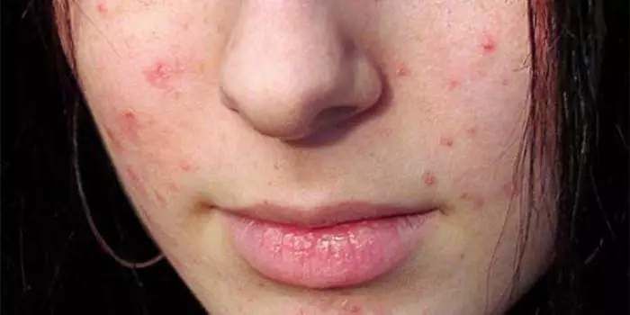 Acne on the face of a girl