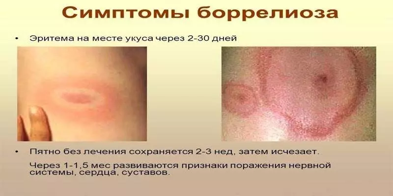 Indwara yo kurumwa iyo yanduye borreliose