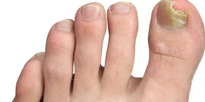 Toenail कवक