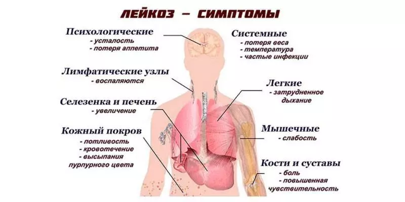 อาการของโรคลูคีเมีย