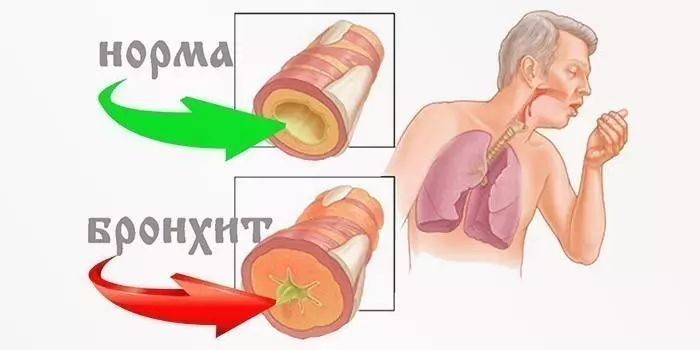 Keuhkoputket ovat normaaleja ja keuhkoputkentulehdus