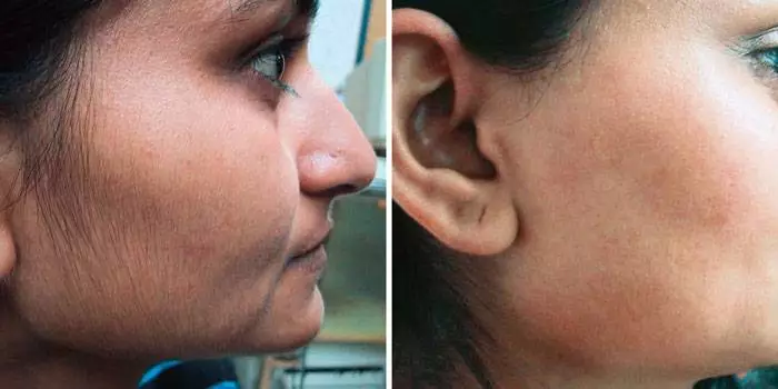 Lézeres szőrtelenítés az arcon: fotók előtt és után