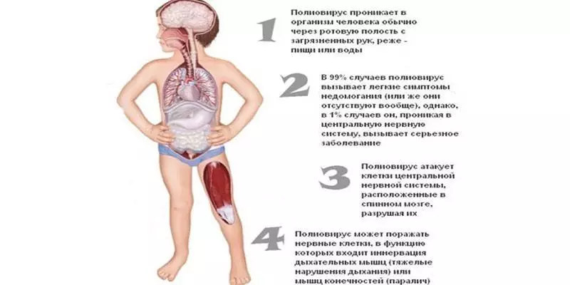 Poliomyelitis ho bana