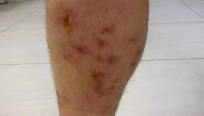Erisipela della pelle delle gambe e delle braccia: sintomi e trattamento a casa