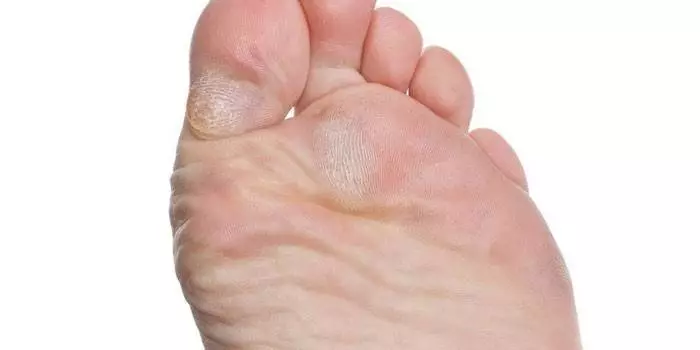 Foot fungus