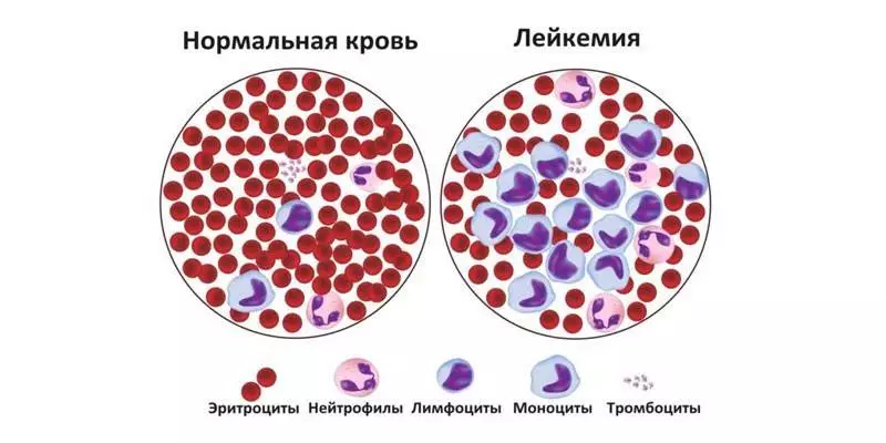 Getih normal sareng leukemia