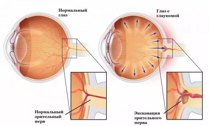 Glawcoma ar y diagram