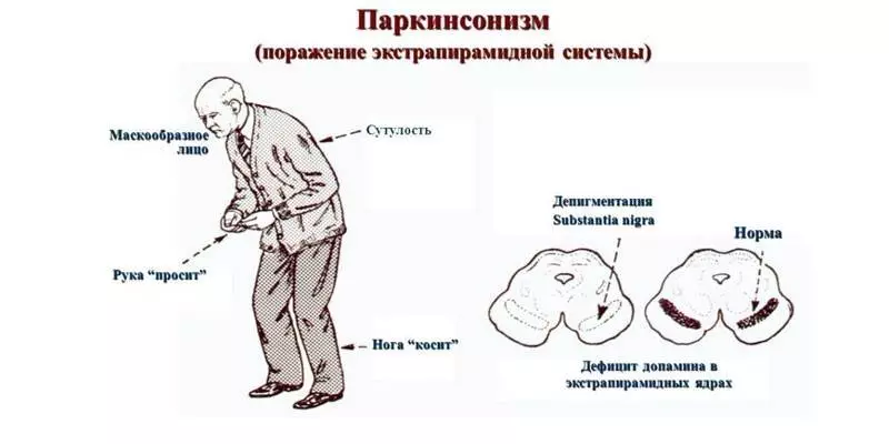 Parkinsonism