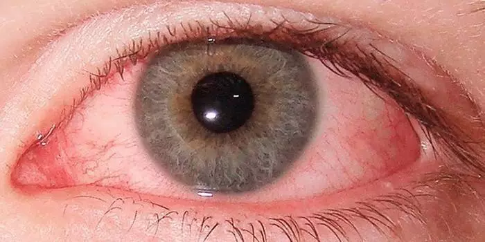 Göz ağrısı