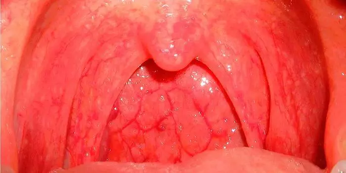 Hiperèmia de la faringe