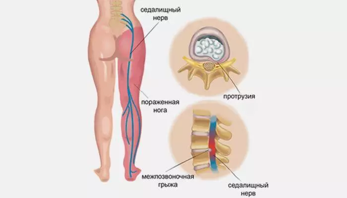 د سایاټیک اعصاب موقعیت