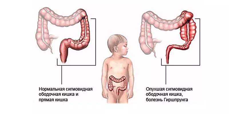 सामान्य sigmoid बृहदान्त्र र Hirschsprung रोग बाट प्रभावित