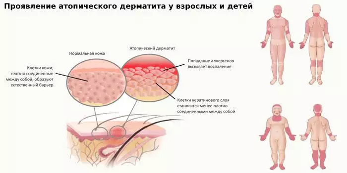 Bayyanar cututtukan atopic dermatitis a cikin yara da manya