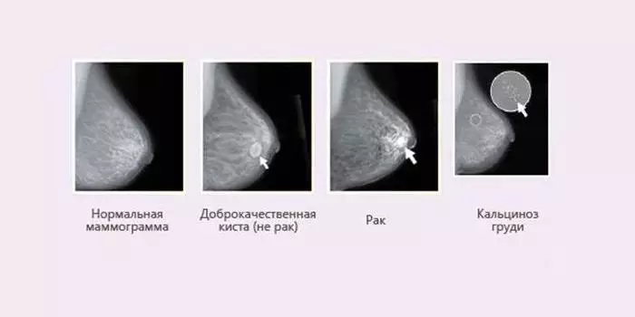 Mammogrammas rezultāts