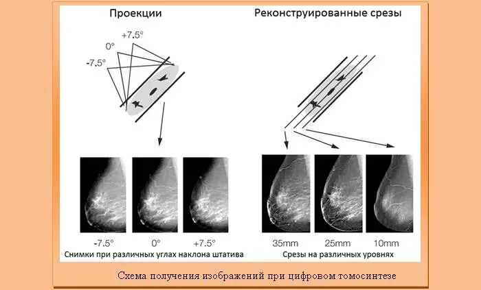 Tomosíntesi mamària