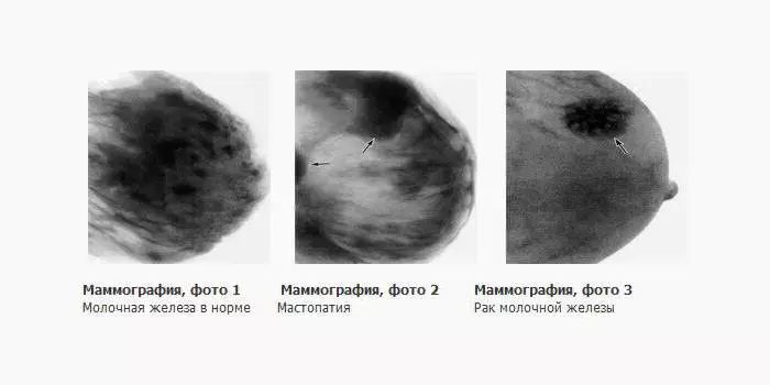 Ergebnis der Mammographie