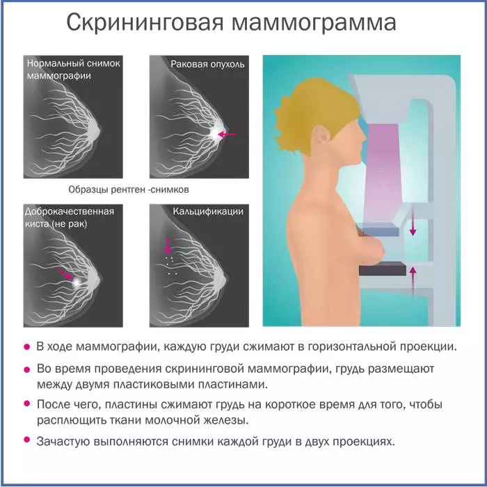 篩查乳房 X 光檢查