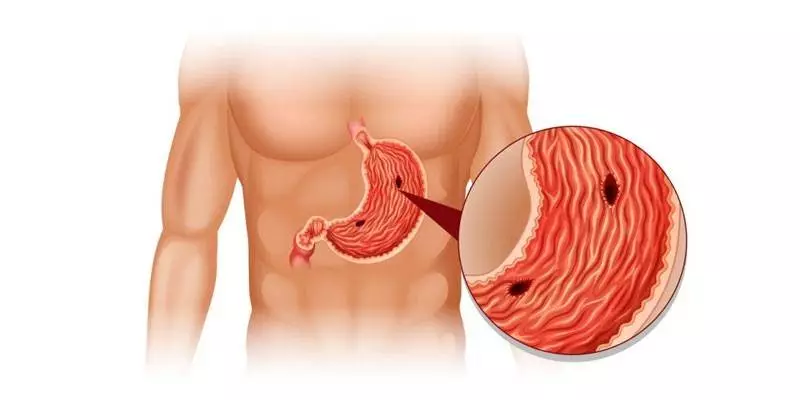 Gastroduodenitis yenye uharibifu