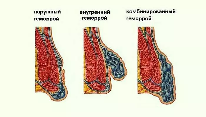 Геморройдун түрлөрүнүн схемасы