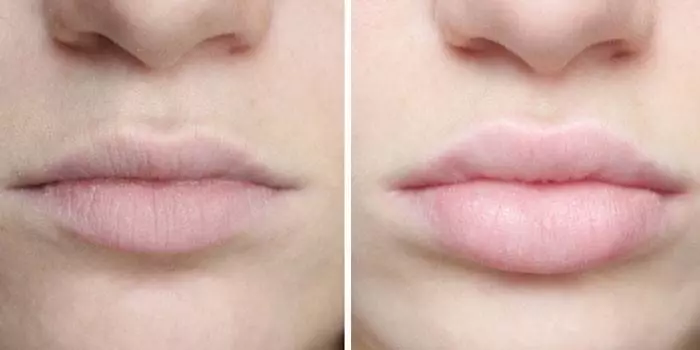 Hyaluronsäure auf den Lippen vorher und nachher