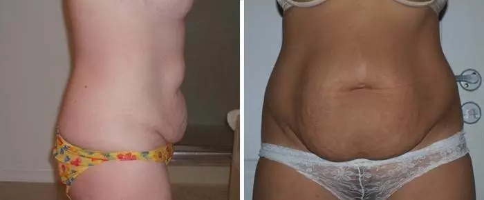 Indications for abdominoplasty of the abdomen: folds and fatty apron