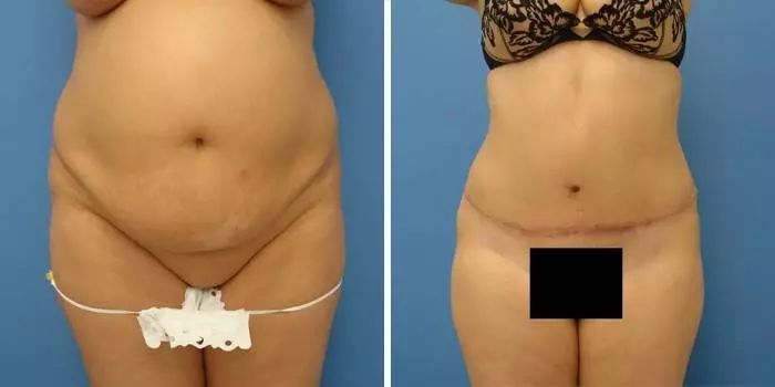 Fotos antes y después de la abdominoplastia de abdomen.