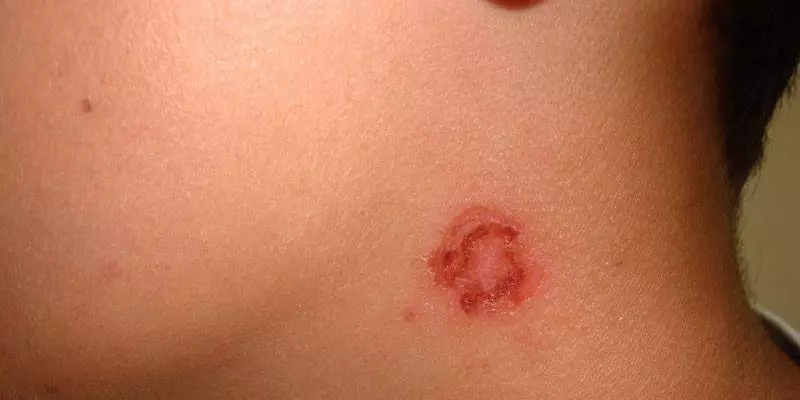 Impetigo streptokokus