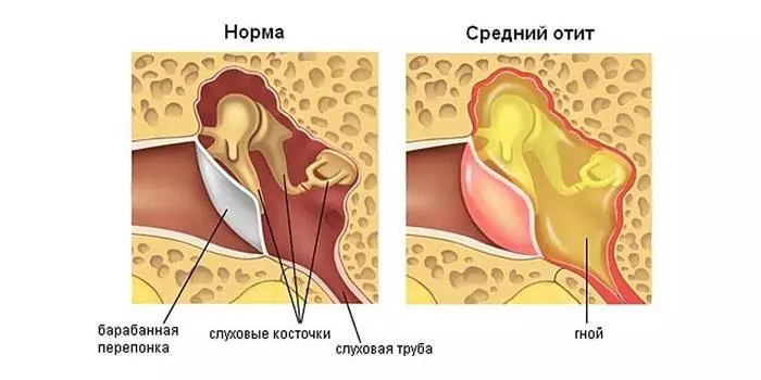 Otitis media