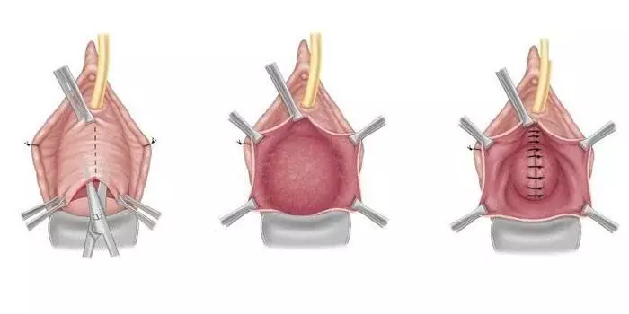 Anterior colporrhaphy