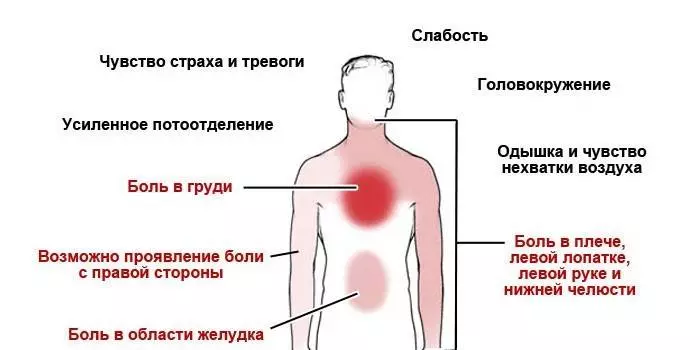 Симптоми на ангина