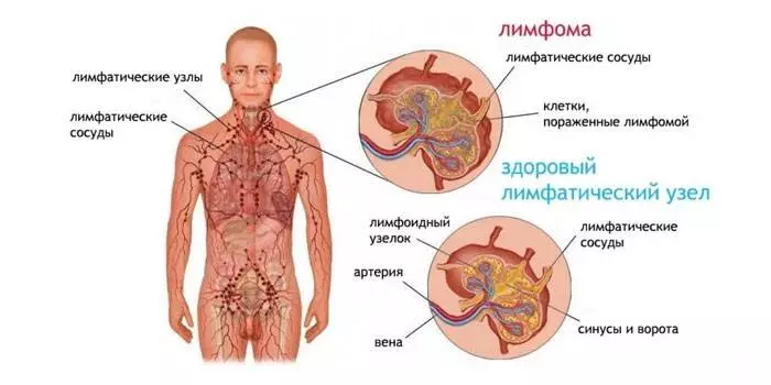 Lymphoma