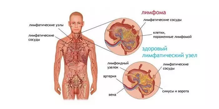 Lymphoma