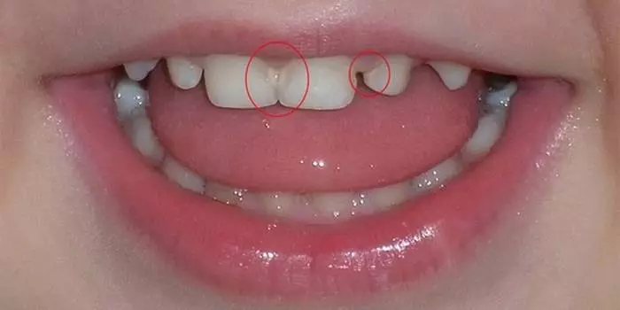 Tooth enamel hyperplasia