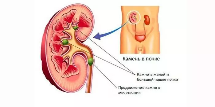 Maladie de la lithiase urinaire