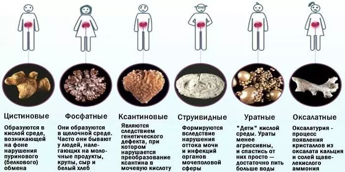 腎臓結石の種類