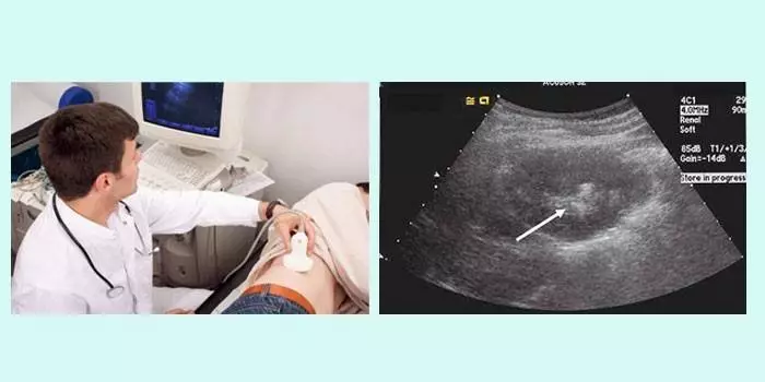 El paciente recibe una ecografía del riñón y el resultado en el monitor.