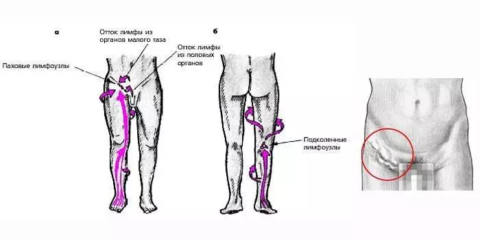 Linfadenite inguinal