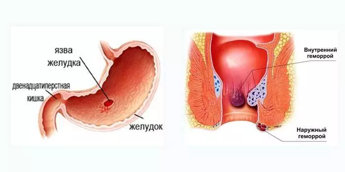 Tásca maidir le teiripe ózóin i gastraenterology