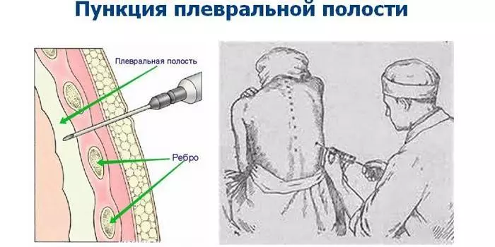 Плевра пункциясы