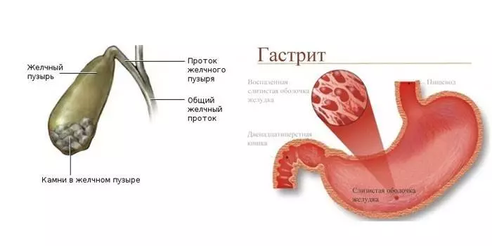 Gastritis en galstene