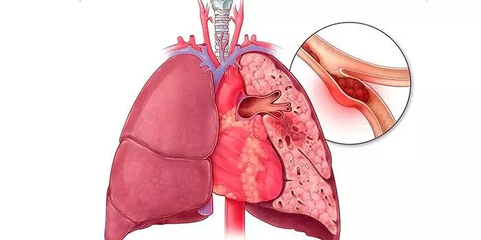 Embolia pulmonar