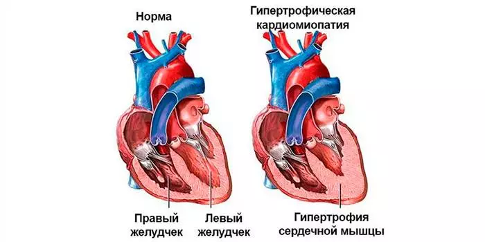 Hypertrofisk kardiomyopati